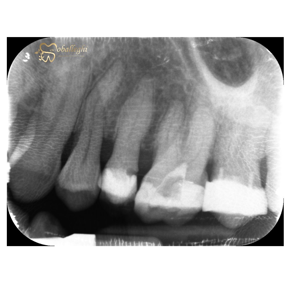 Sample Cases – Dr Moballeghi – Endodontics